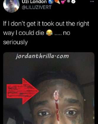 Lil Uzi Vert Could Die After Pink Diamond Implant Causes Serious Injury ...