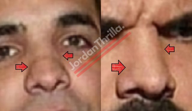 Did Drake Get a Nose Job Plastic Surgery?