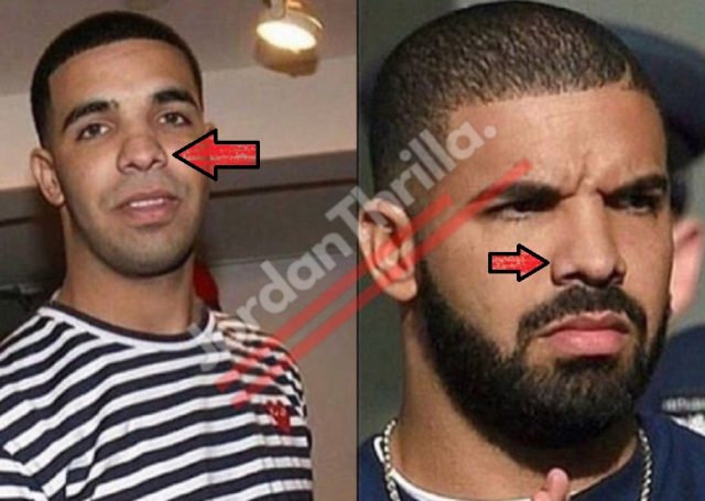 Did Drake Get a Nose Job Plastic Surgery?