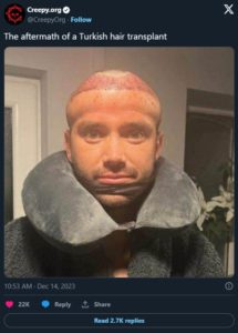 Why a Horrific Photo Showing the Aftermath of a Man's Turkish Hair ...