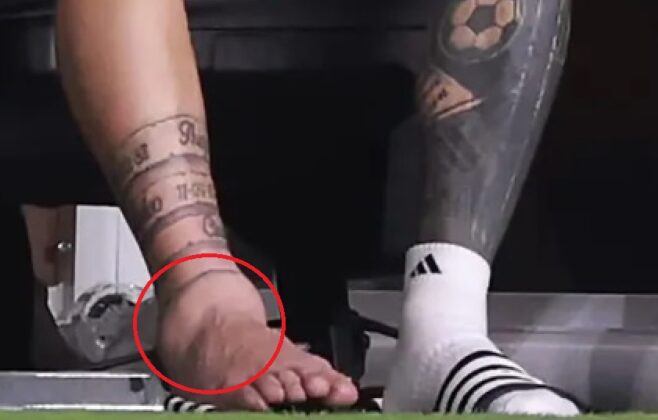 Here's the Real Reason Why Lionel Messi's Swollen Right Ankle During ...