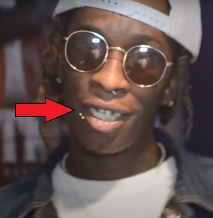 Young Thug's Rotten Teeth Before the Fame Goes Viral